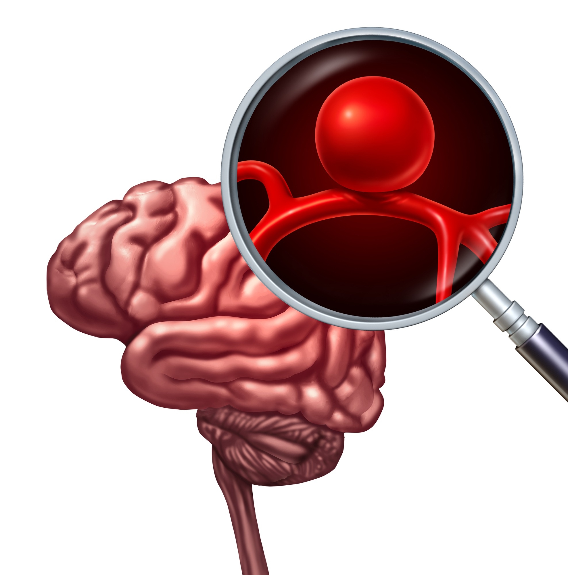 Aneurysms An Overview Aneurysms An Overview